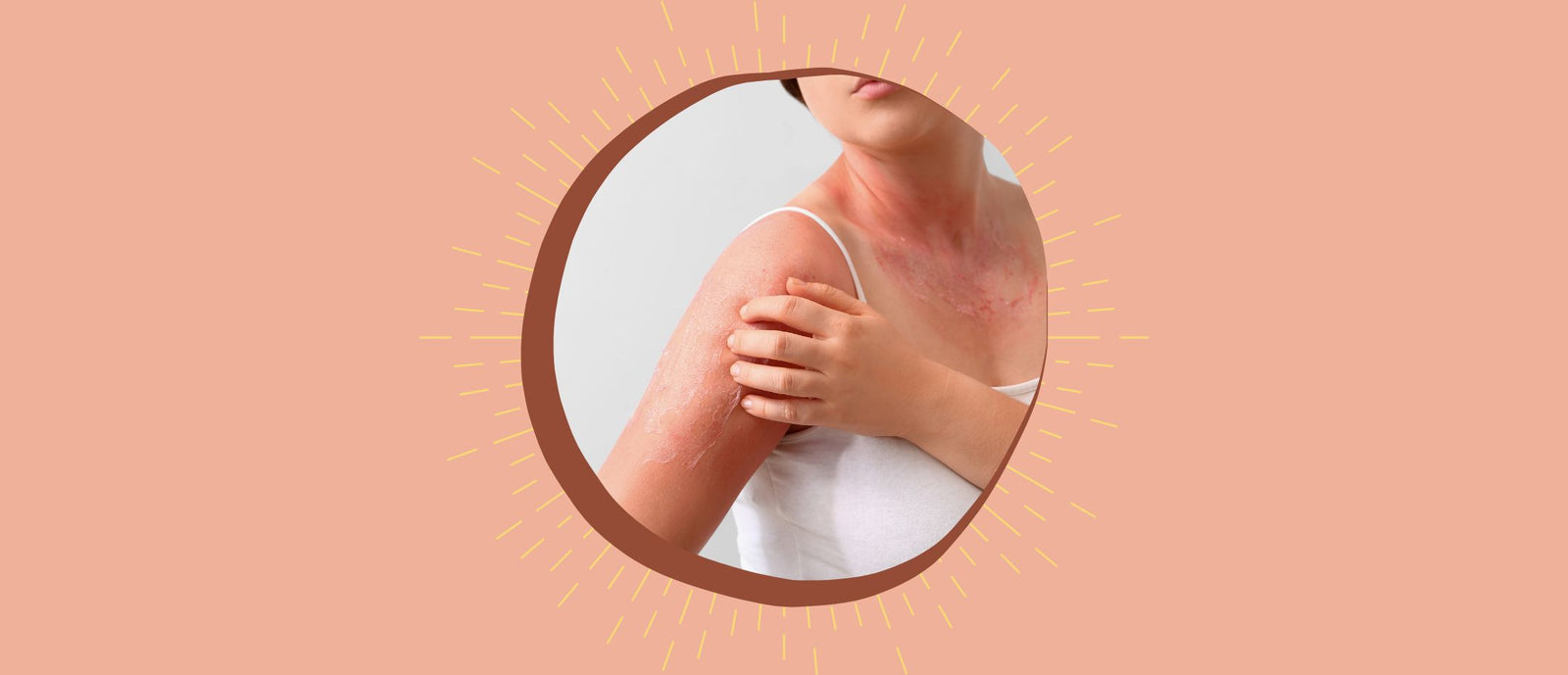 Sleep with a sunburn: tips that work | Polysleep